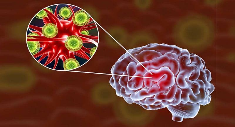 Cabot-Health-Brain-Infection | Cabot Health