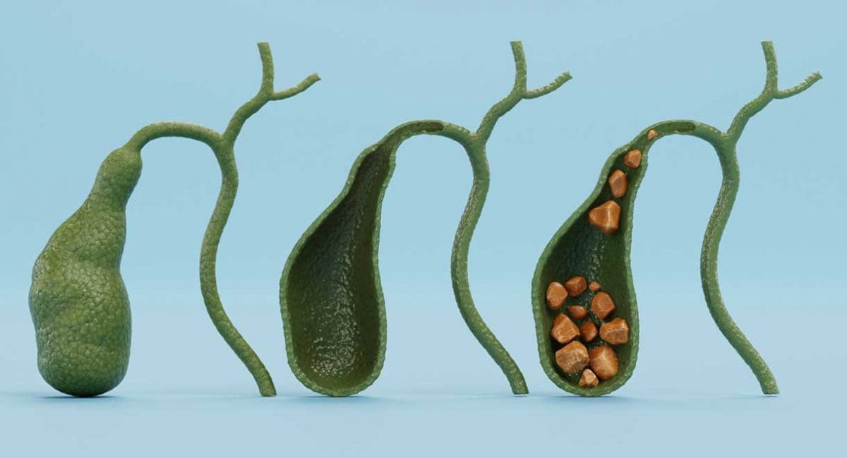 What Causes Gallbladder Problems? | Cabot Health