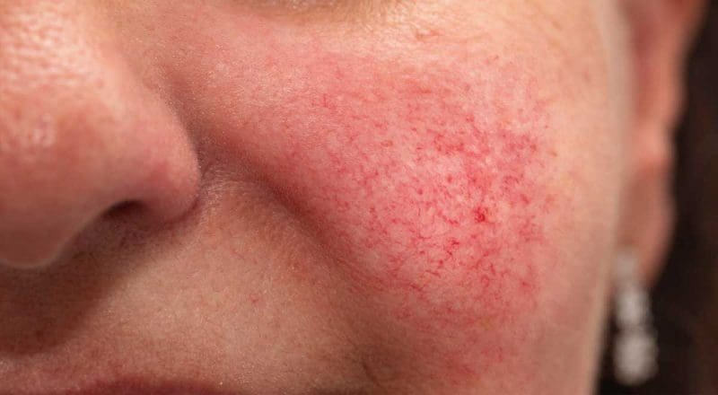 Your Face Gives Clues About Your Blood Sugar | Cabot Health