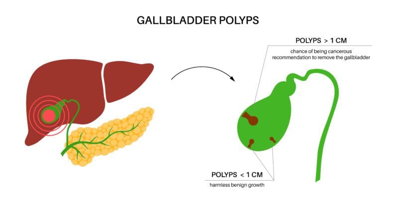 Gallbladder polyp anatomy | Cabot Health
