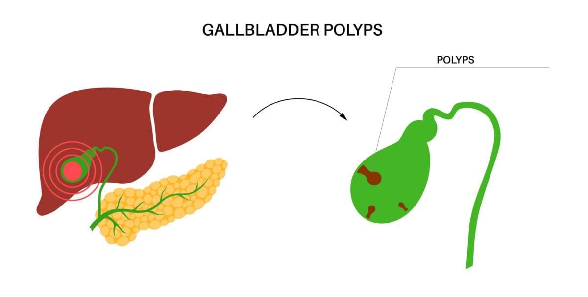 What To Do About Gallbladder Polyps | Cabot Health