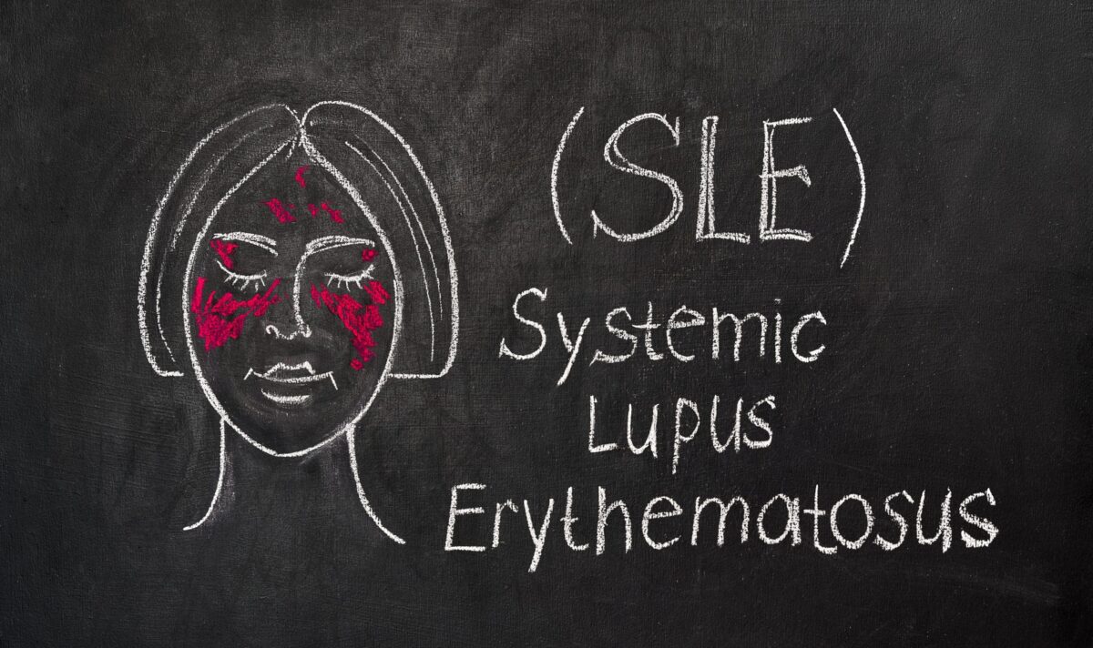 Systemic lupus erythematosus (SLE), is the most common type of lupus ...